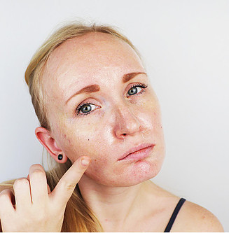 Why does everything I put on my face burns? | Web Skincare Solution