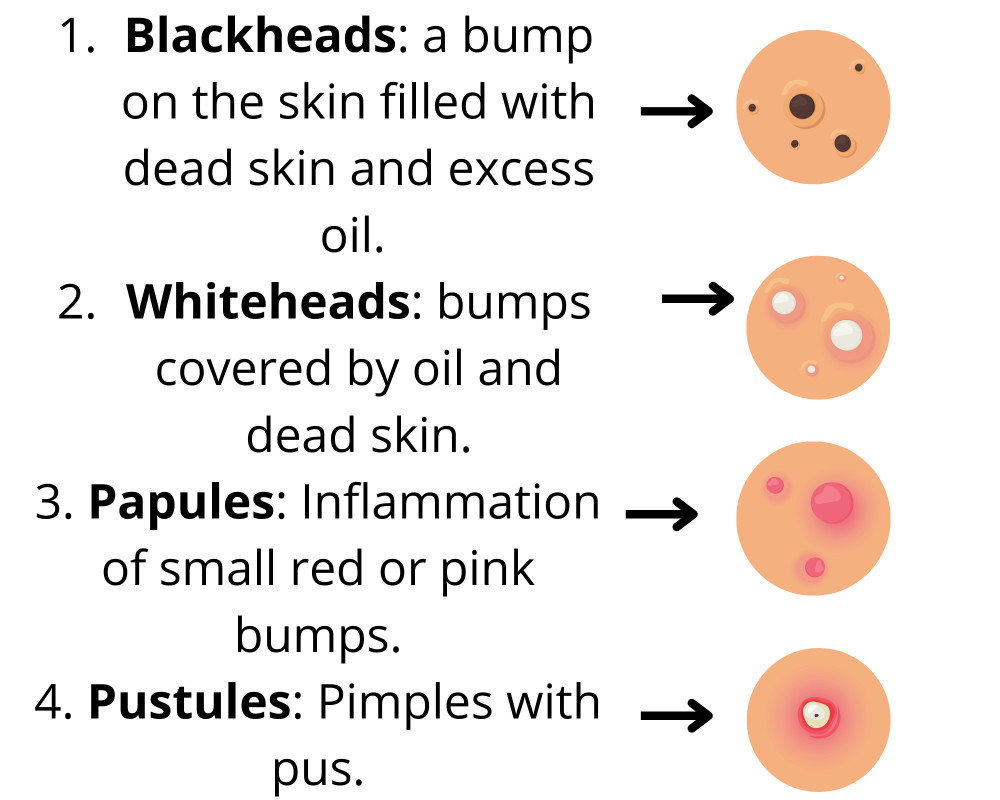 Suffering from Acne on Dry Sensitive Skin? | Web Skincare Solution