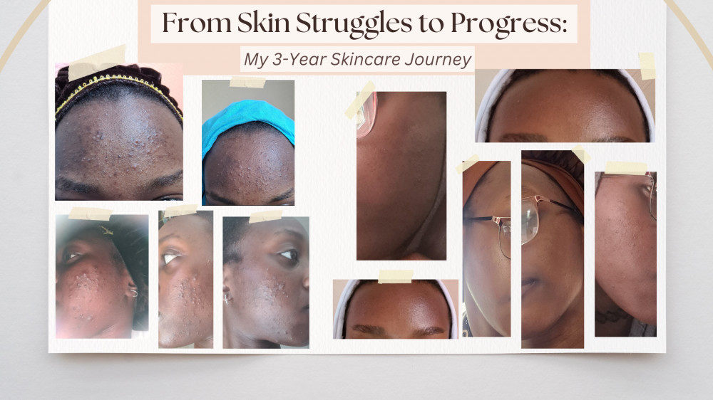 From Skin Struggles to Progress: My 3-Year Skincare Journey | Web ...