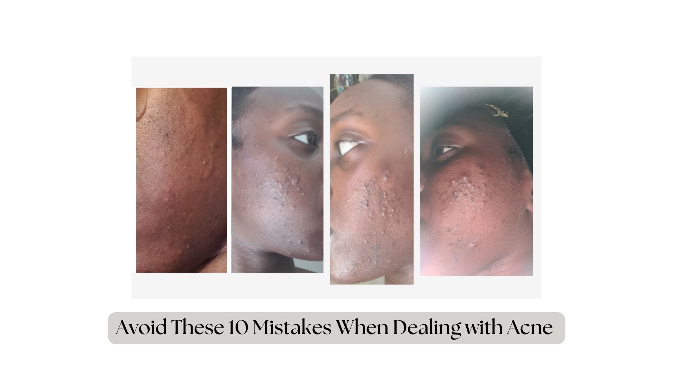 Avoid These 10 Mistakes When Dealing With Acne | Web Skincare Solution