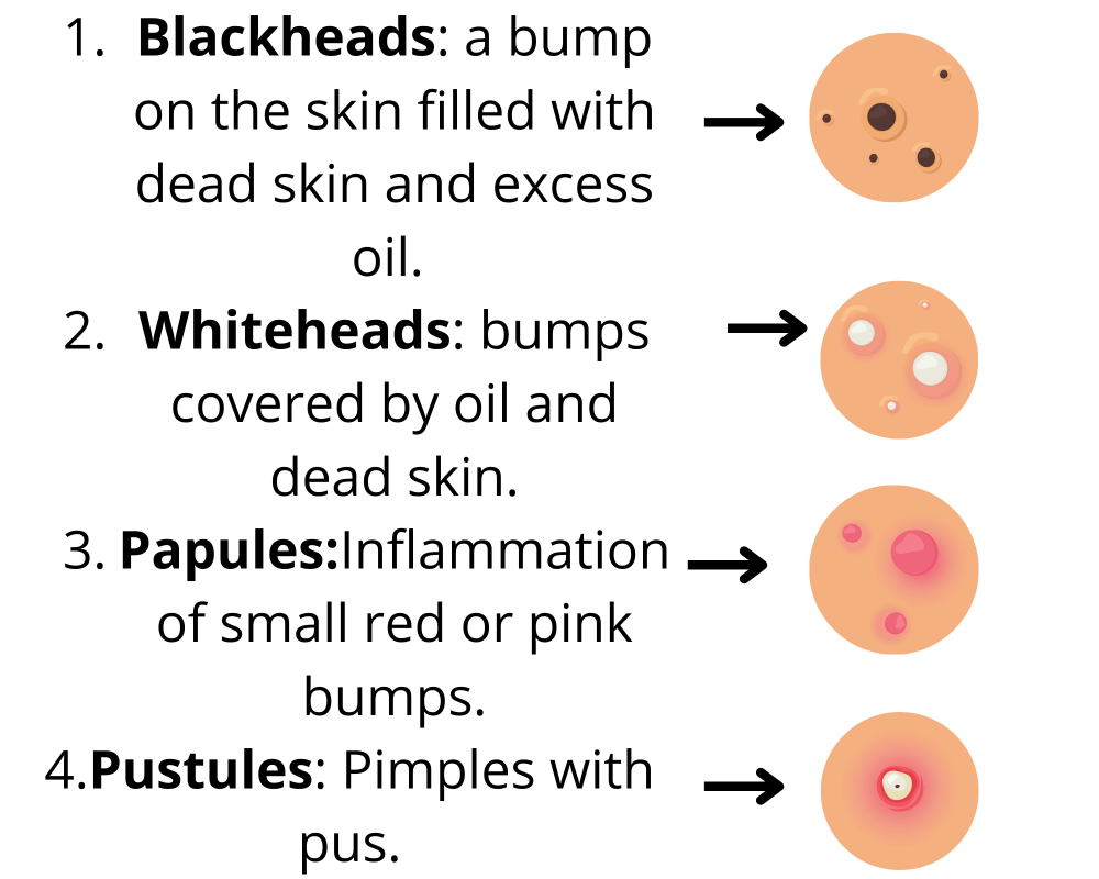Dealing With Acne And How To Find A Solution | Web Skincare Solution