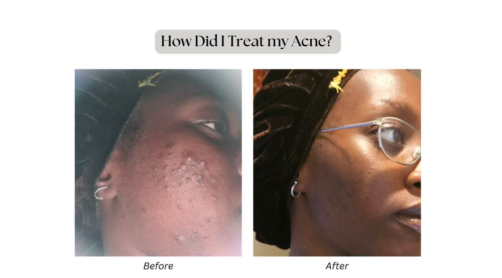 How Did I Treat My Acne? | Web Skincare Solution
